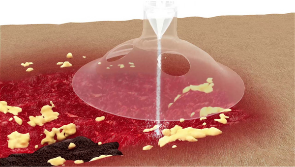 Cutting Edge Tech: Hydro-debridement with JetOx™ | BIHOCL Blog – Biomiq